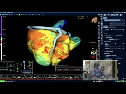 Live Case: PVC Ablation | Marchlinski Electrophysiology Lab at Penn ...