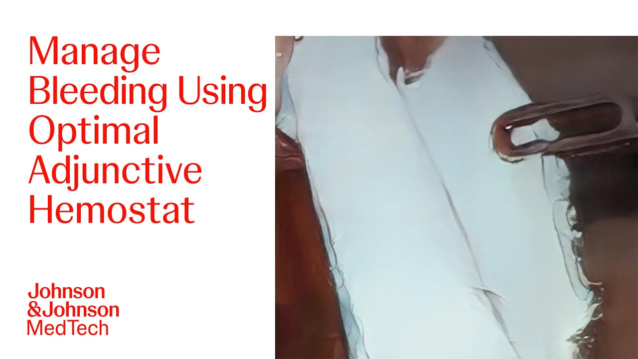 How to Use ETHIZIA Hemostatic Sealing Patch in Problematic Bleeding ...