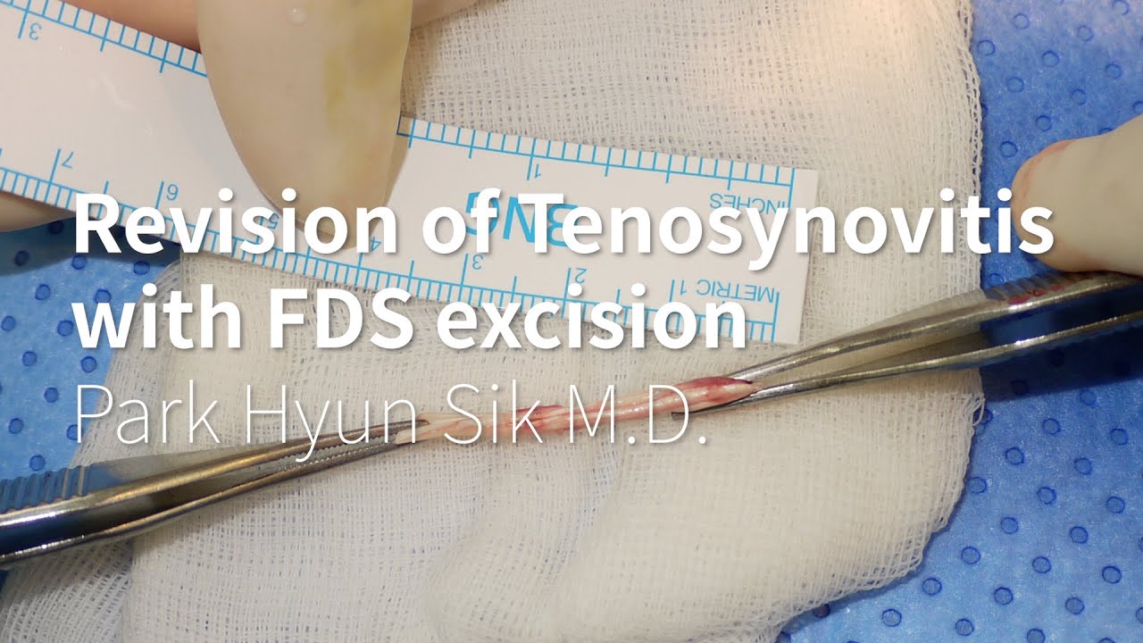 Revision of tenosynovitis. After complete release of A1 pulley. - YouTube