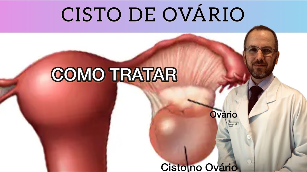 TUDO SOBRE O CISTO NO OV RIO YouTube TUDO SOBRE O CISTO NO OV RIO YouTube