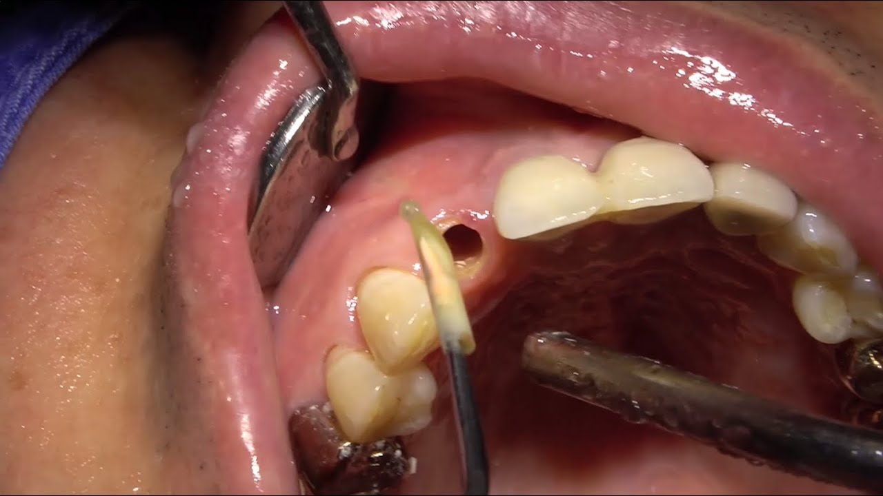 Guided Root membrane techinque?! - YouTube