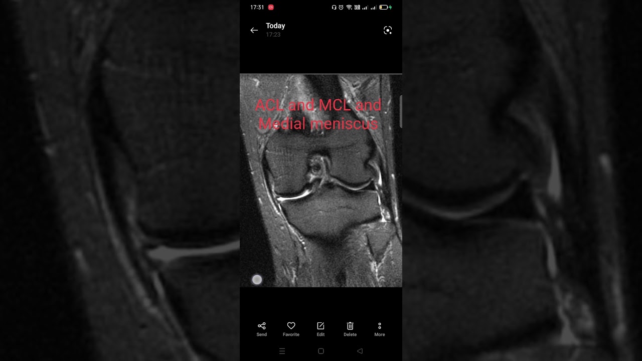 Mri knee, unhappy triad - YouTube