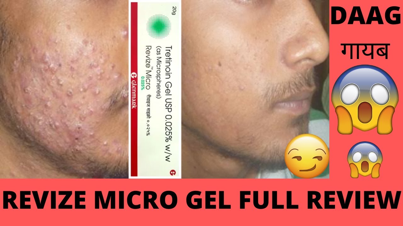 Revize Micro Gel Full Review! 🌟 Clear Skin की ओर एक यात्रा | # ...