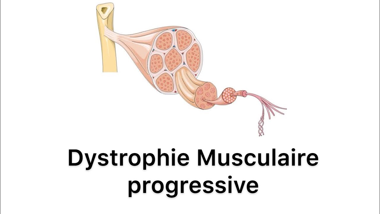 🔻 Dystrophie musculaire Progressive part one | Neurologie | 4ème année ...