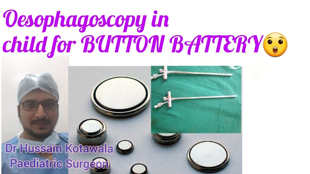 Oesophagoscopy(Rigid) with Button Battery Cell Removal - YouTube