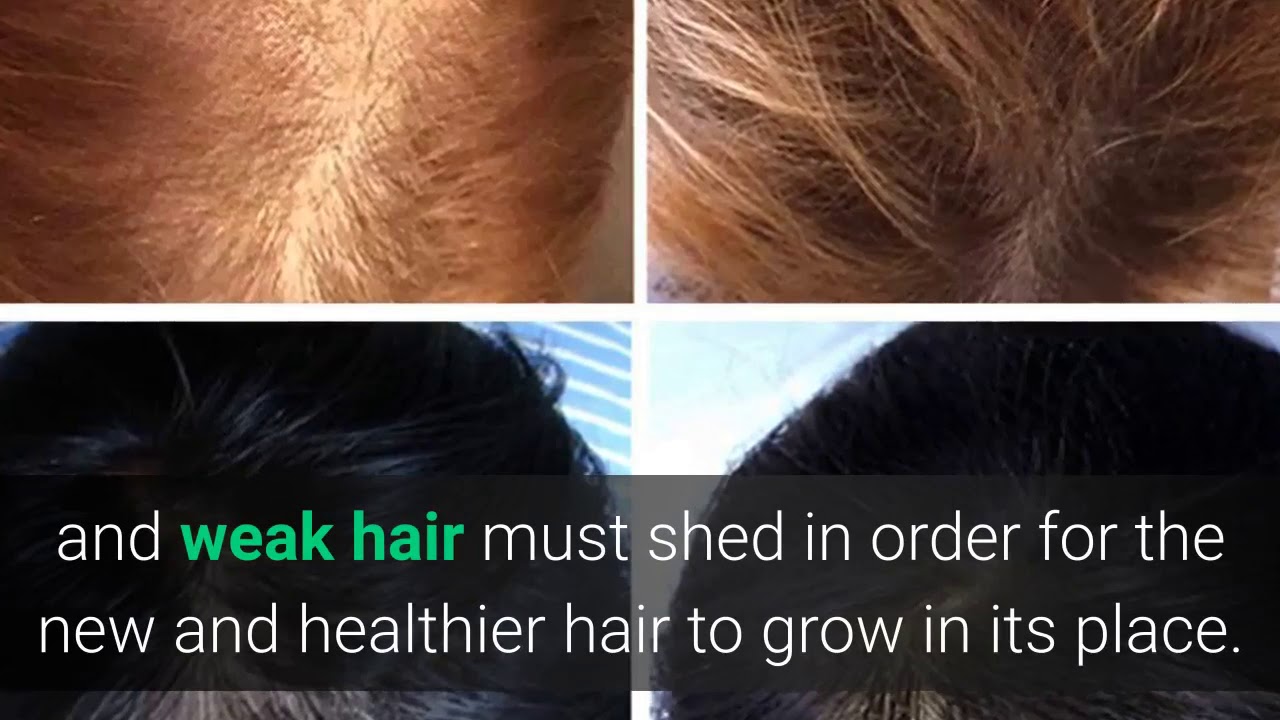 Go through a shedding process after starting use of Laser Hair Growth ...