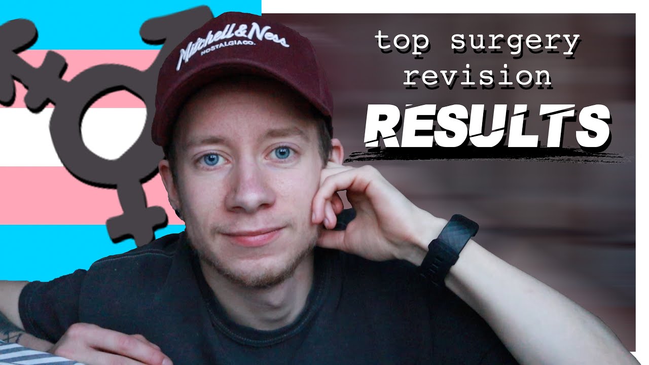 1,5 MONTHS AFTER MY TOP SURGERY REVISION - YouTube