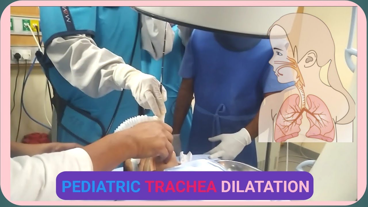 Subglottic Stenosis Dilatation #BD_ENDOSCOPY - YouTube
