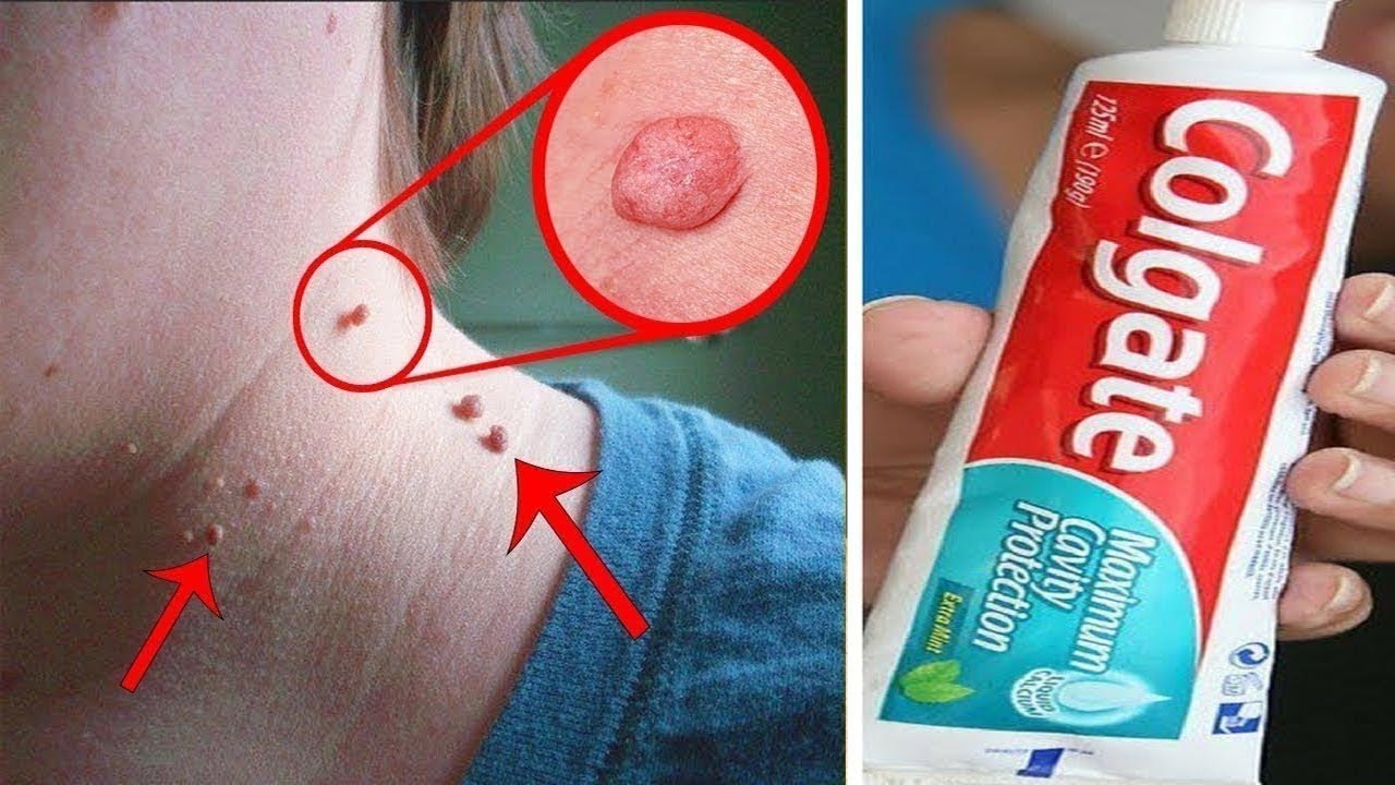 How to remove skin tags naturally permanently, Best natural way for ...