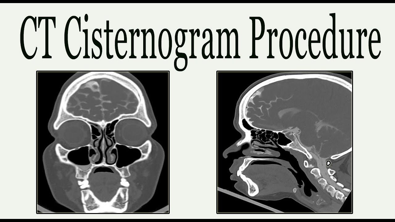 CT cisternogram procedure - YouTube