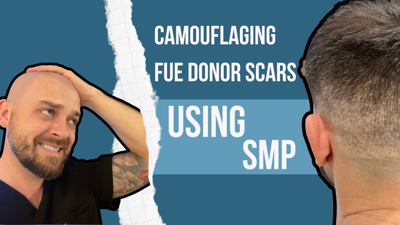 Using SMP to Camouflage an FUE Hair Transplant Donor Area - YouTube