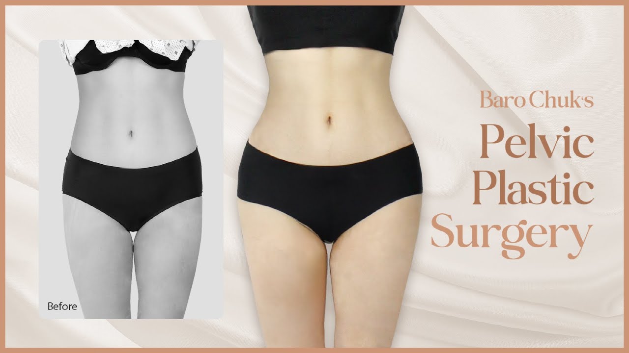 Pelvic plastic surgery available in Korea #BAROCHUK - YouTube