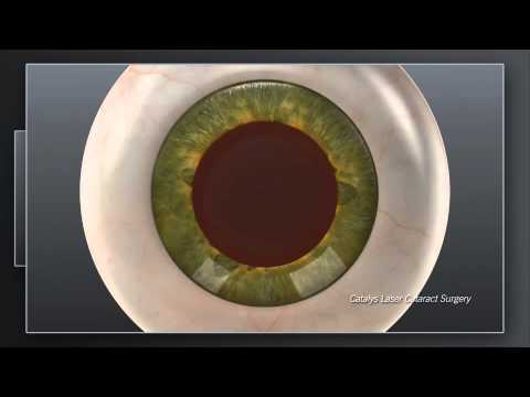 Catalys Laser Cataract Surgery in San Diego at Clearview - YouTube