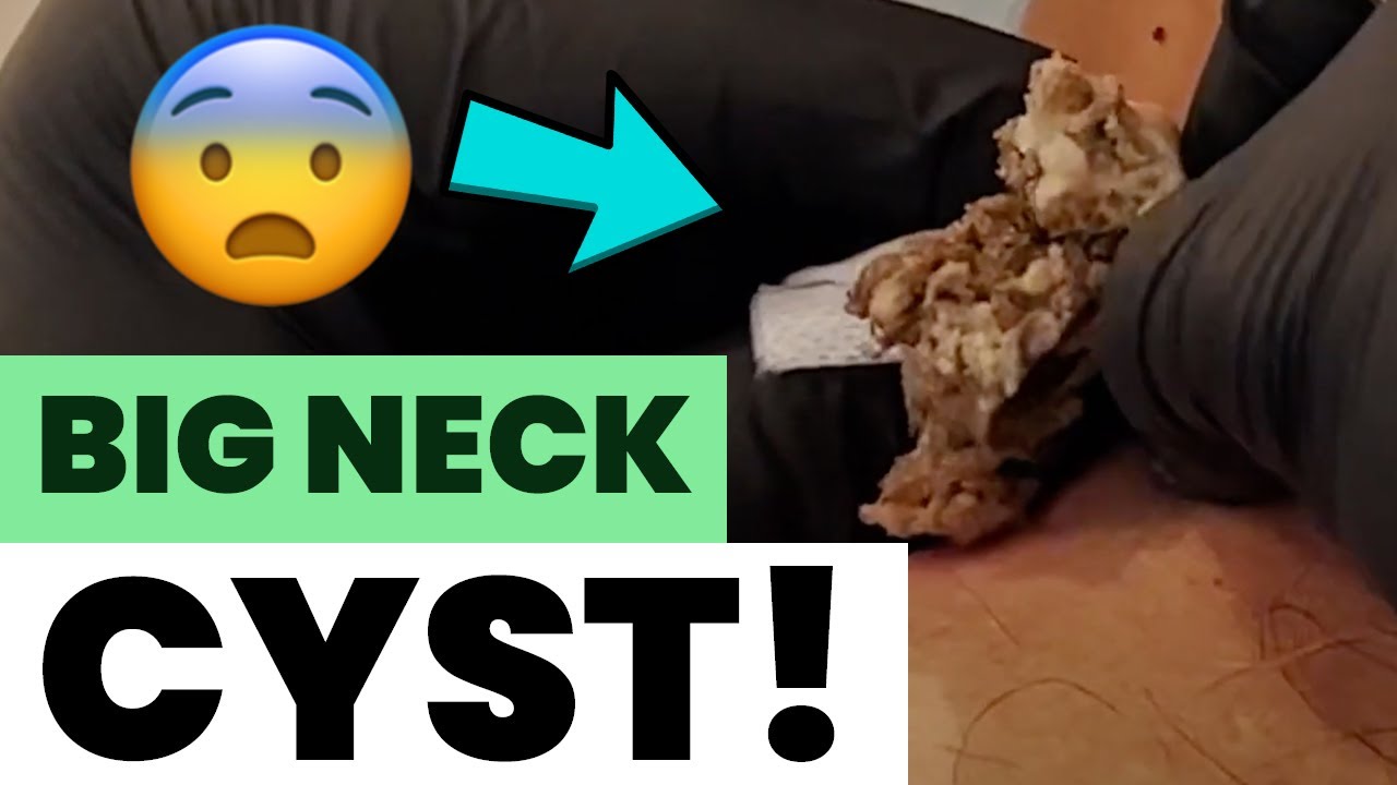 BIG NECK CYST! - YouTube