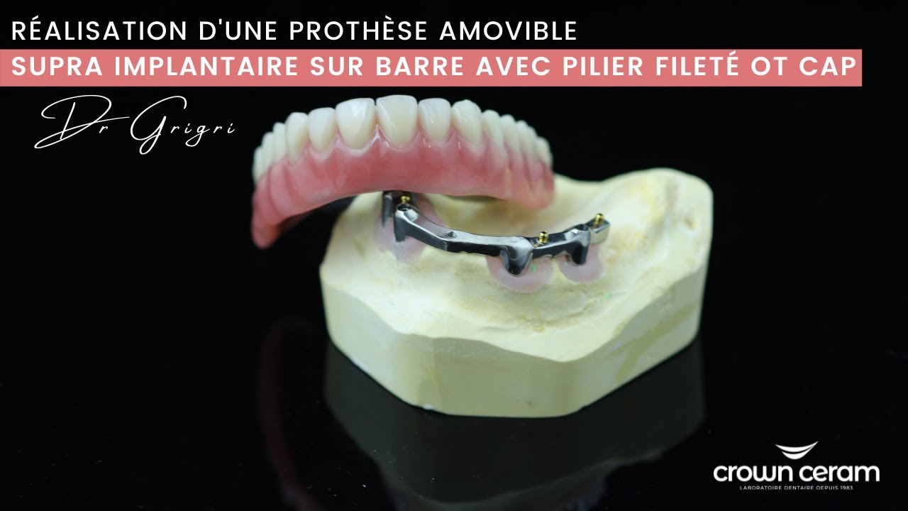 Réalisation d'une prothèse amovible supra implantaire sur barre avec ...