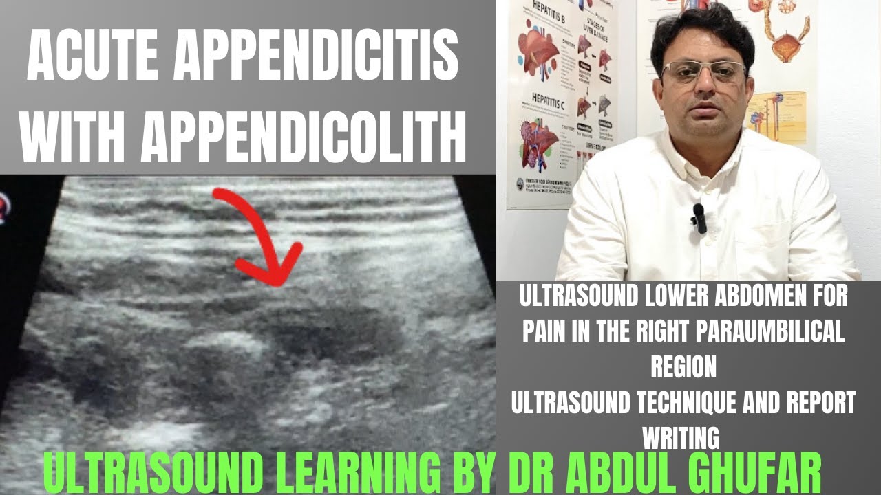Acute Appendicitis ultrasound | Appendicolith | Fecolith Abdominal ...