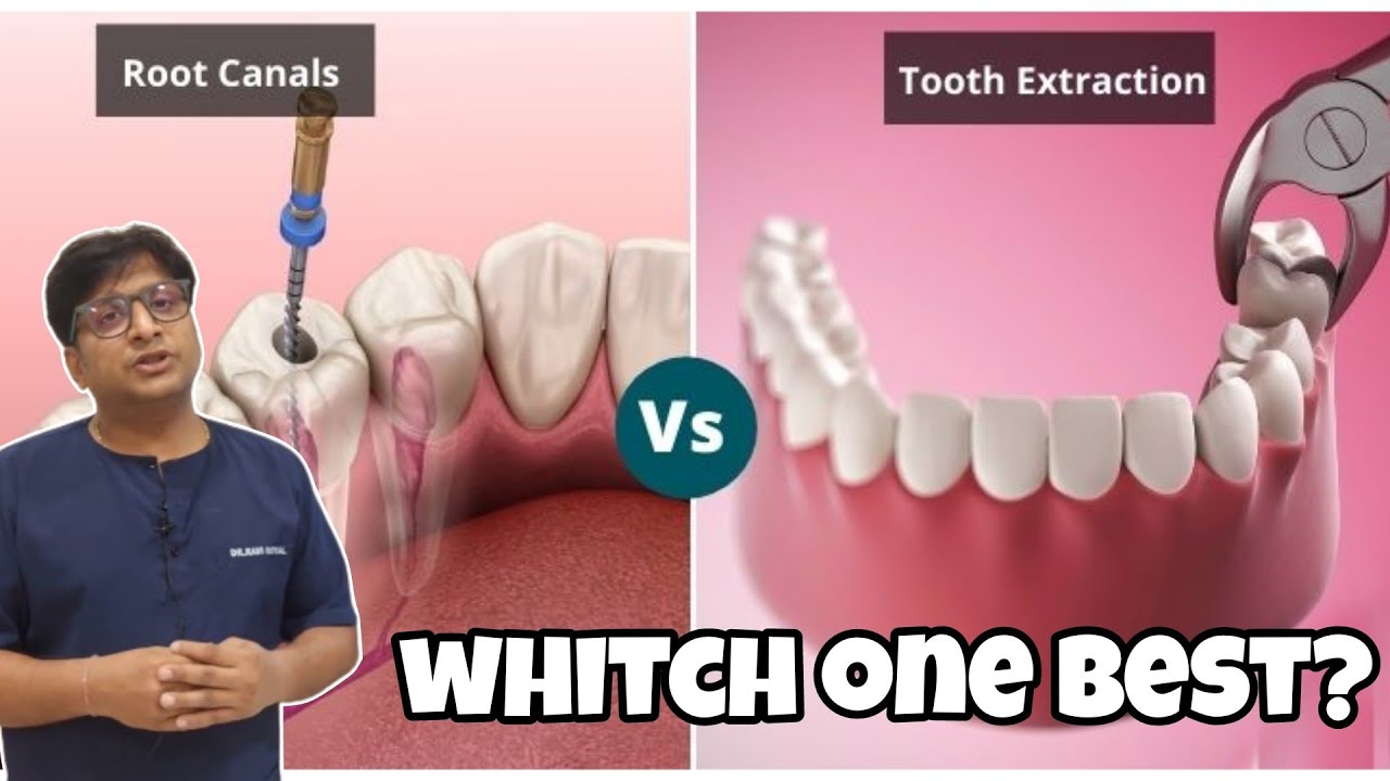 Root canal Vs Tooth Extraction | Chhattisgarh Dental Hospital | Dr ...