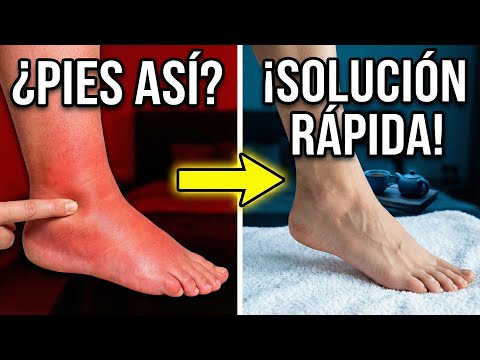 ¿Pies y Tobillos Hinchados por Retención de Líquidos? Este Remedio Natural SÍ Funciona