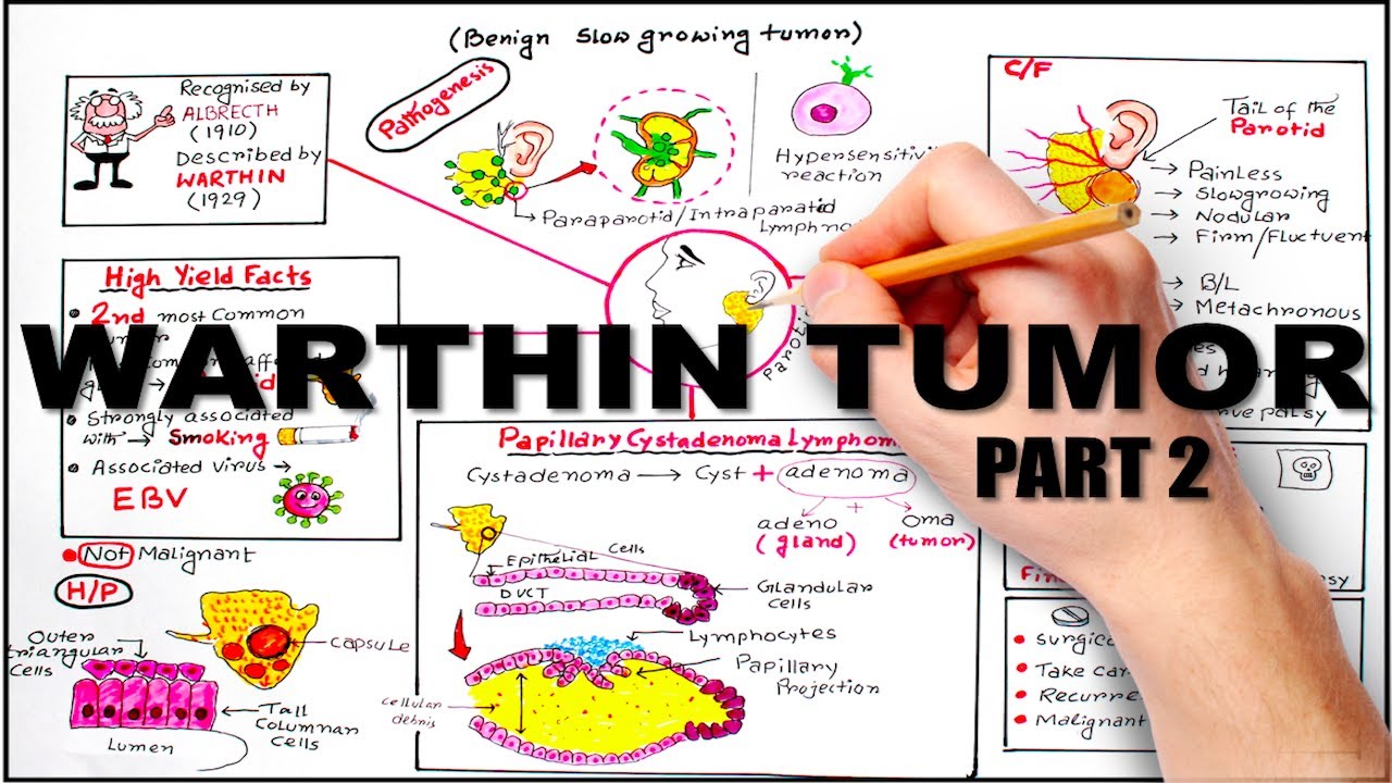 Warthin Tumor (Salivay Gland Neoplasm) - part 2 - YouTube