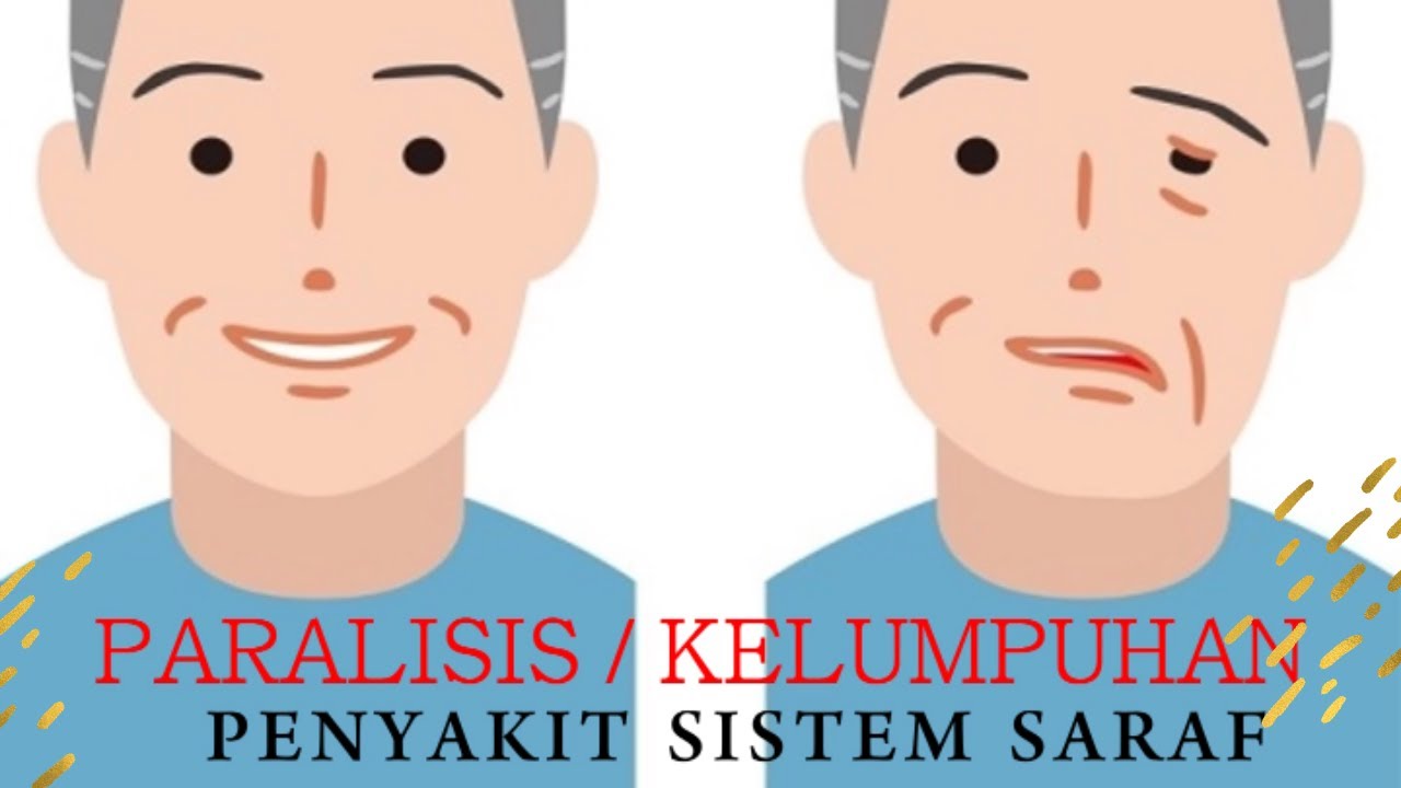 PARALISIS ATAU KELUMPUHAN - YouTube