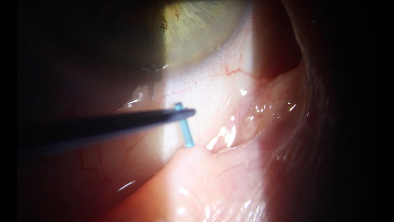 Punctal Plug Insertion YouTube punctal-plug-insertion-youtube