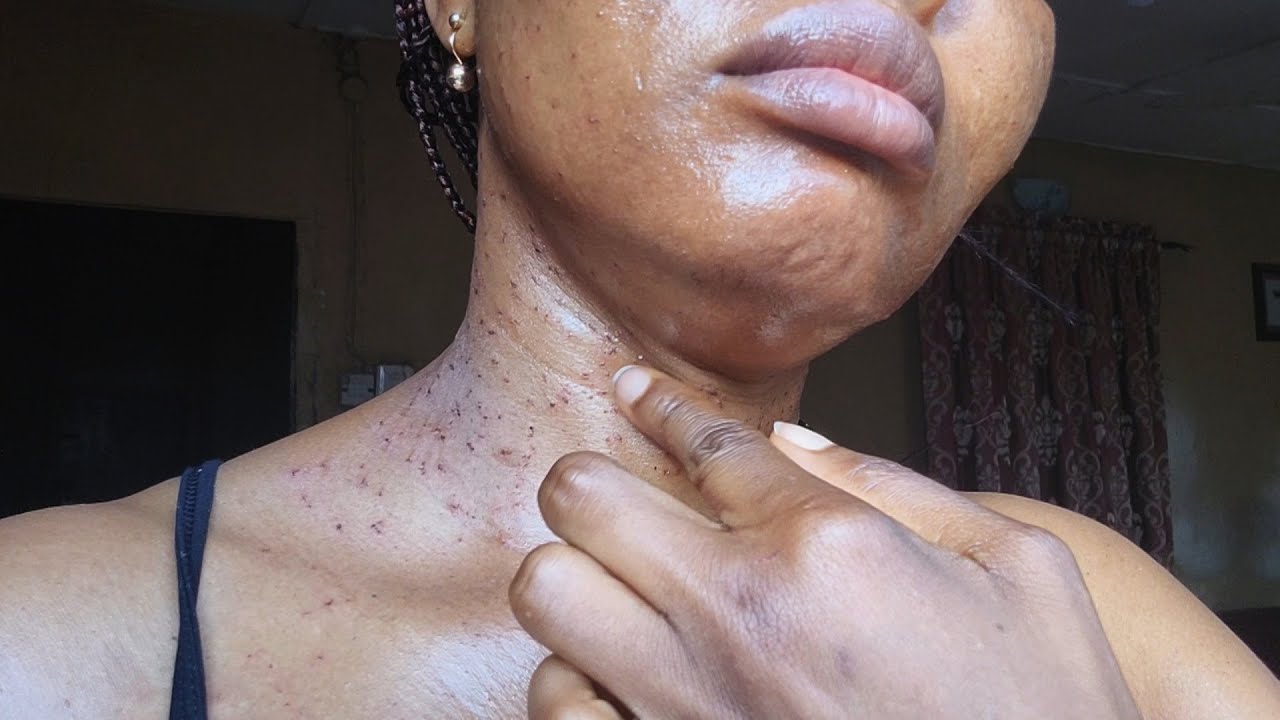 How I Removed My Skin Tags In Lagos, Nigeria | Who sent me? | Flo ...