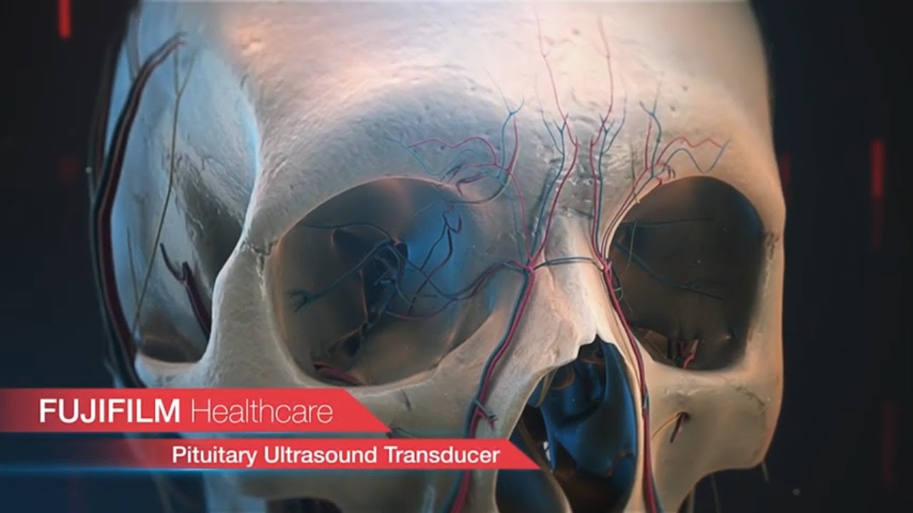 Brain Tumor Visualization (3D medical animation) - YouTube
