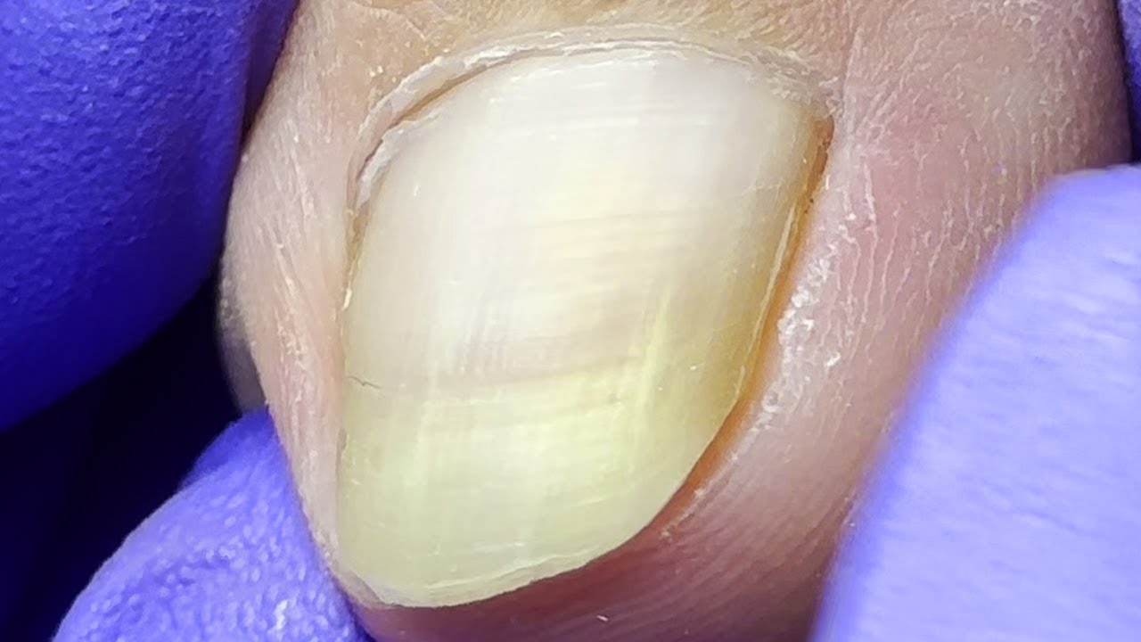 Nails that have not been trimmed for several months with deep ingrown ...