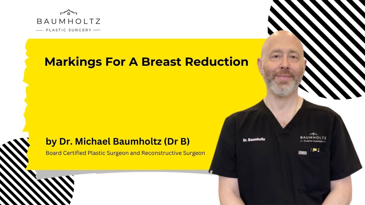 Markings For A Breast Reduction - YouTube