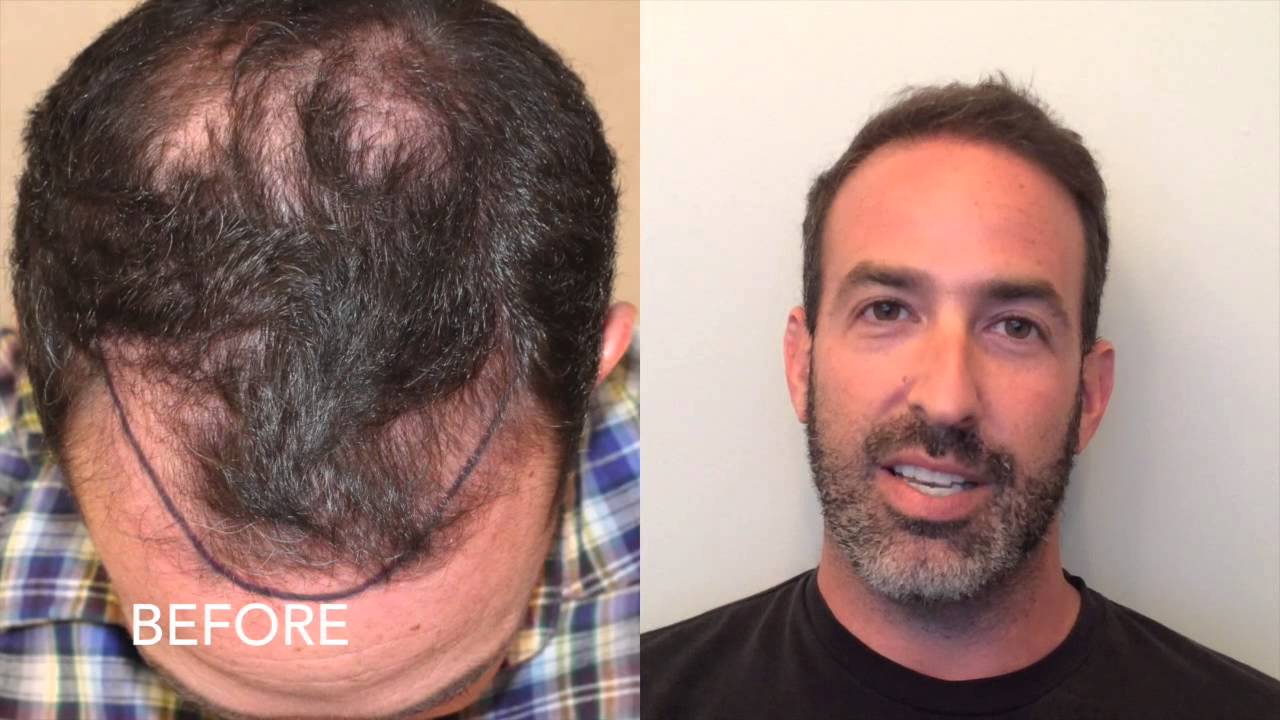 FUE Hair Transplant Testimonial- Patient of Dr. Marc Dauer - YouTube