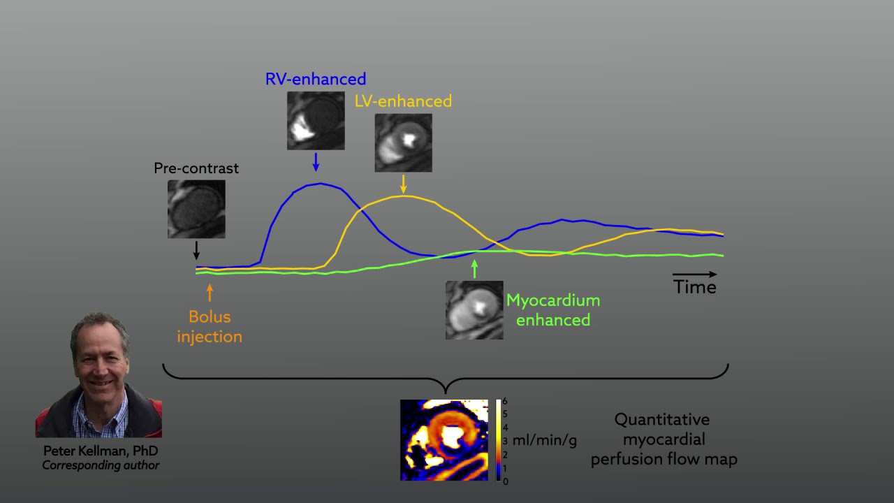 Automated MRI method to visualize blood flow in the heart - YouTube