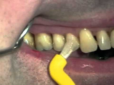 How to use the floss loop and ISB - YouTube