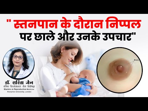 Milk Blebs During Breastfeeding: Causes and Remedies  | Dr Sarita Jain