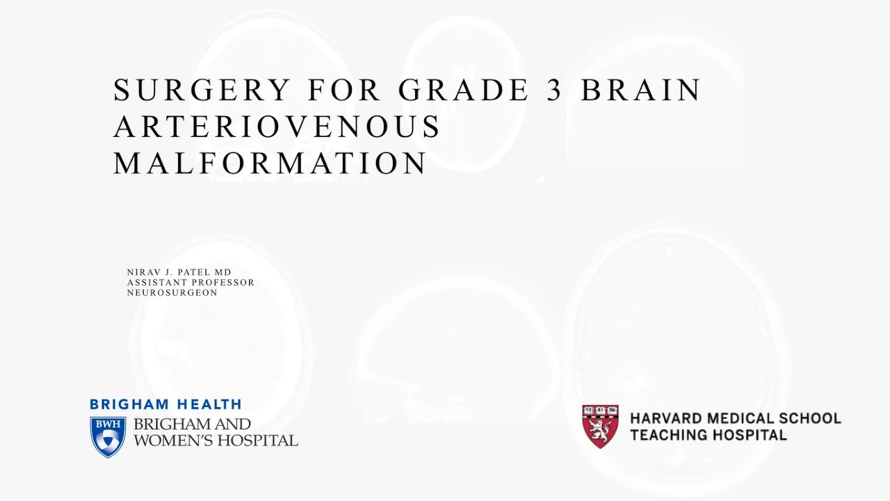 Surgical Video for Resection of a Grade 3 Brain AVM - YouTube