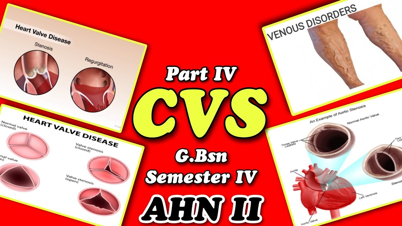 Varicose vein & Deep vein Thrombosis | Heart valves diseases | Stenosis ...