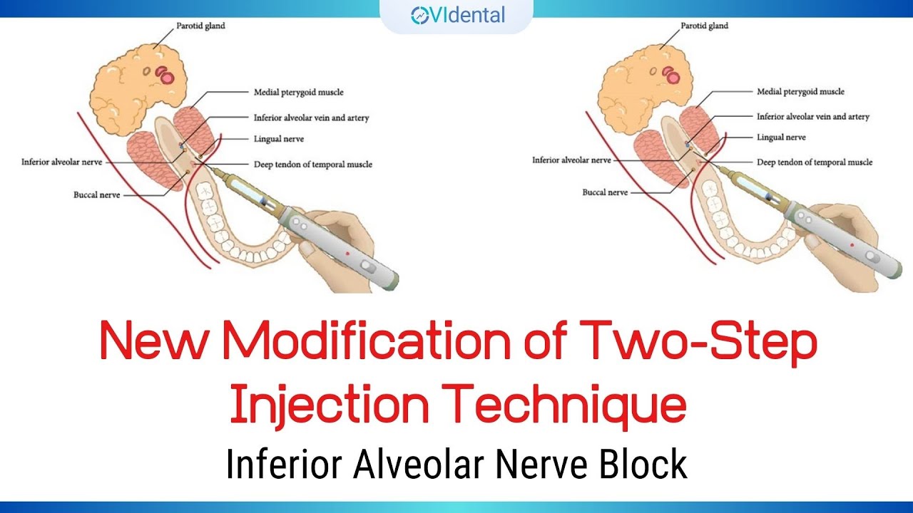 IANB: New Modification of Two Step Injection Technique - YouTube