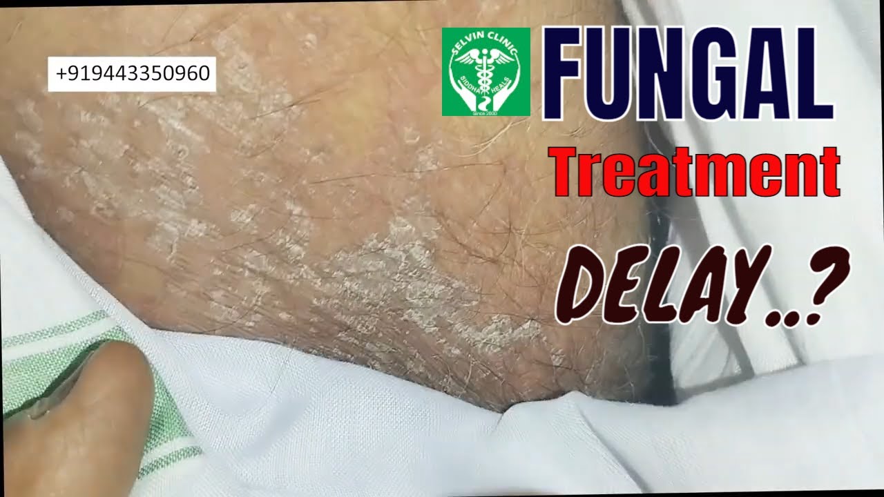 FUNGAL INFECTION IN PRIVATE AREAS I DELAYED HEALING I HOW TO TAKE CARE ...
