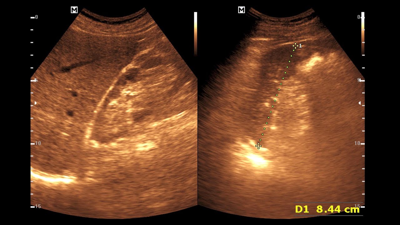 Ultrasound cases 96 of 2000 || Video Showing Tiny stone CBD with ...