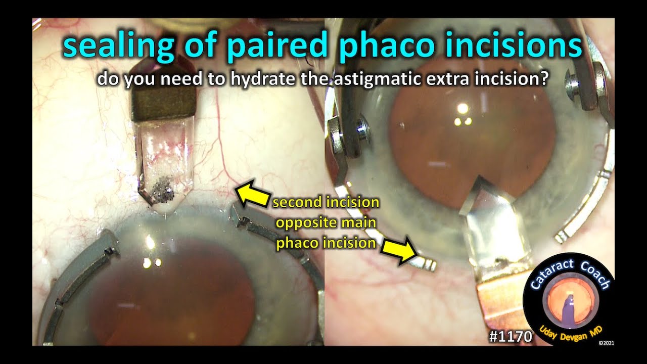 CataractCoach 1170: sealing of paired phaco incisions for astigmatism ...
