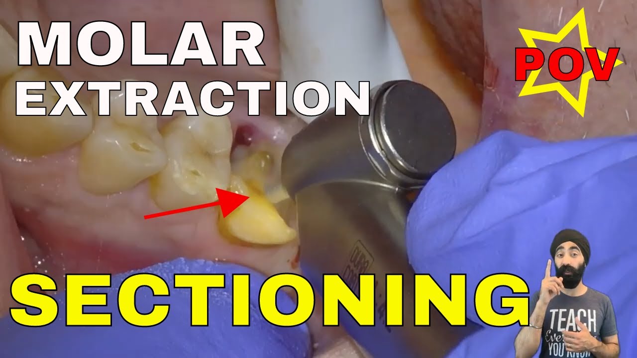 CLINICAL TUTORIAL: Upper Molar EXTRACTION with Electric Handpiece ...