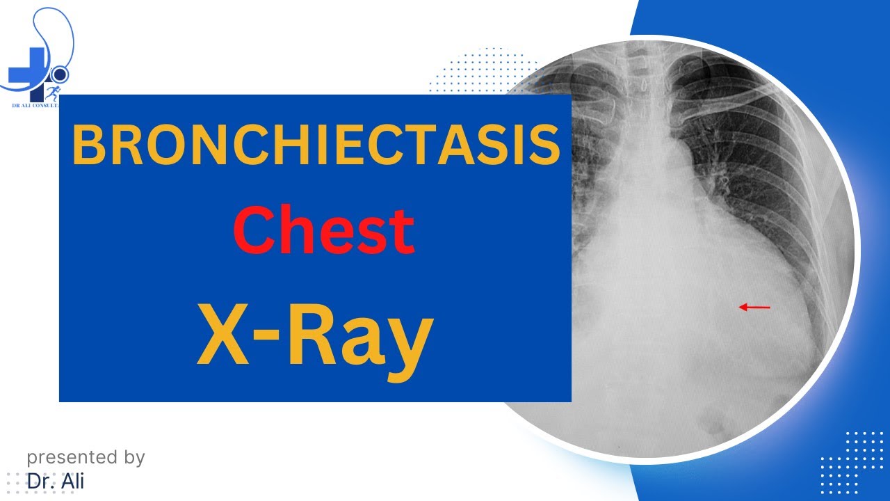 Bronchiectasis X Ray: Bronchiectasis Chest X Ray Findings - YouTube