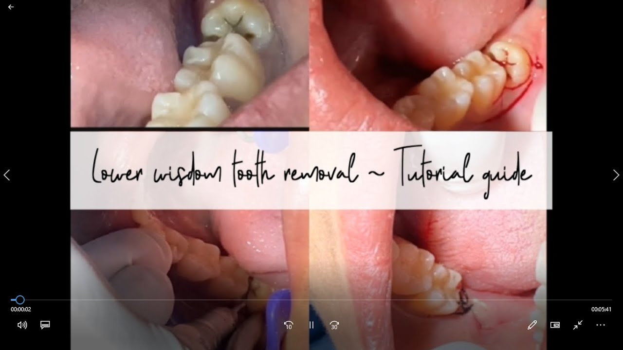 Surgical removal of Mesioangular wisdom teeth having dilacerated root ...