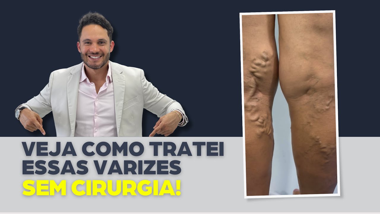 Varizes grossas - veja esse caso! #varizes #varizessemcirurgia # ...