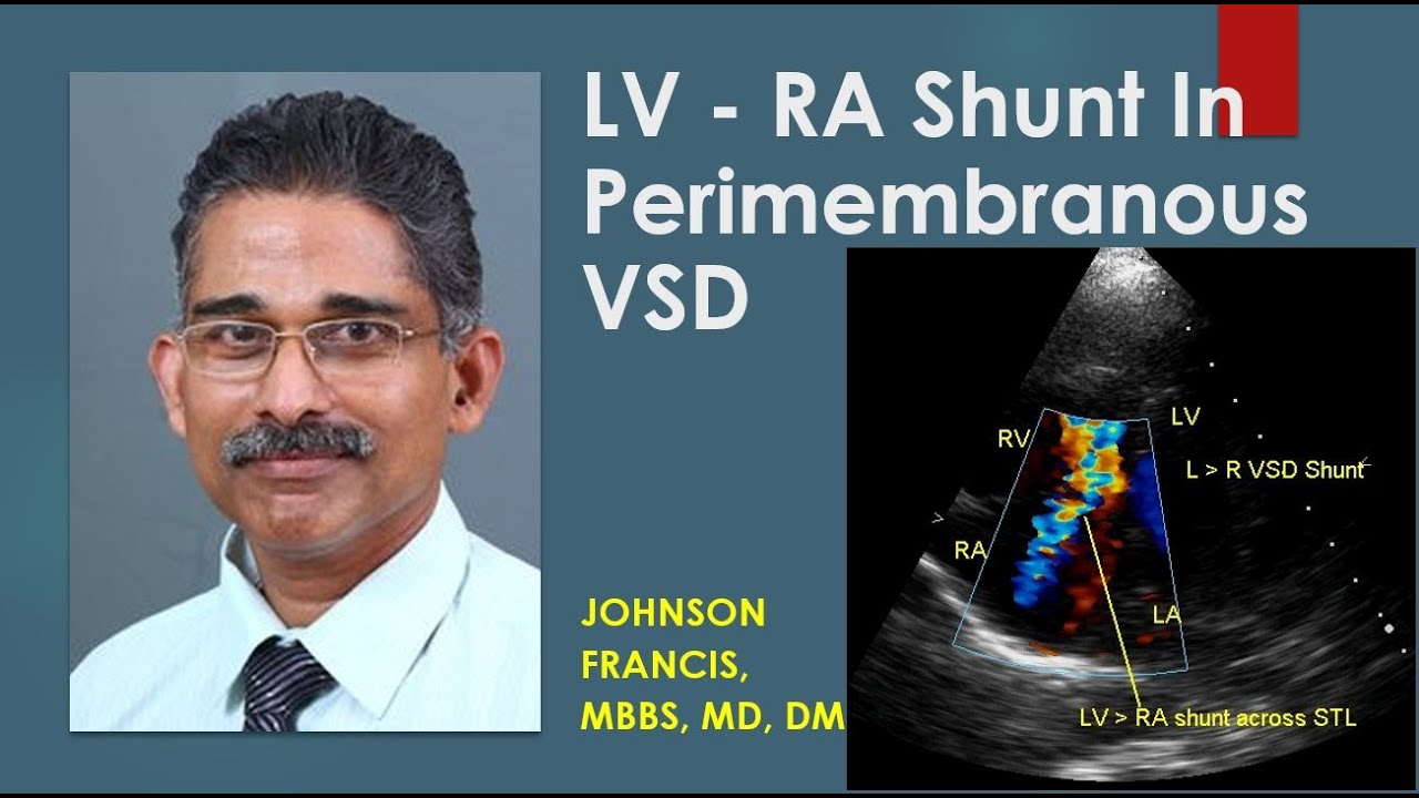 LV - RA Shunt In Perimembranous VSD - YouTube