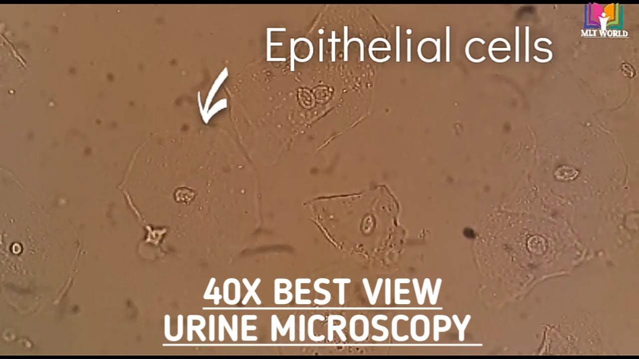Epithelial Cells Seen In Urine Microscopy Showing Urinary Tract epithelial-cells-seen-in-urine-microscopy-showing-urinary-tract