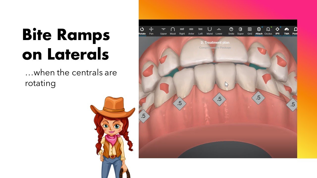 Invisalign ClinCheck - Bite ramps on laterals and occlusal ...