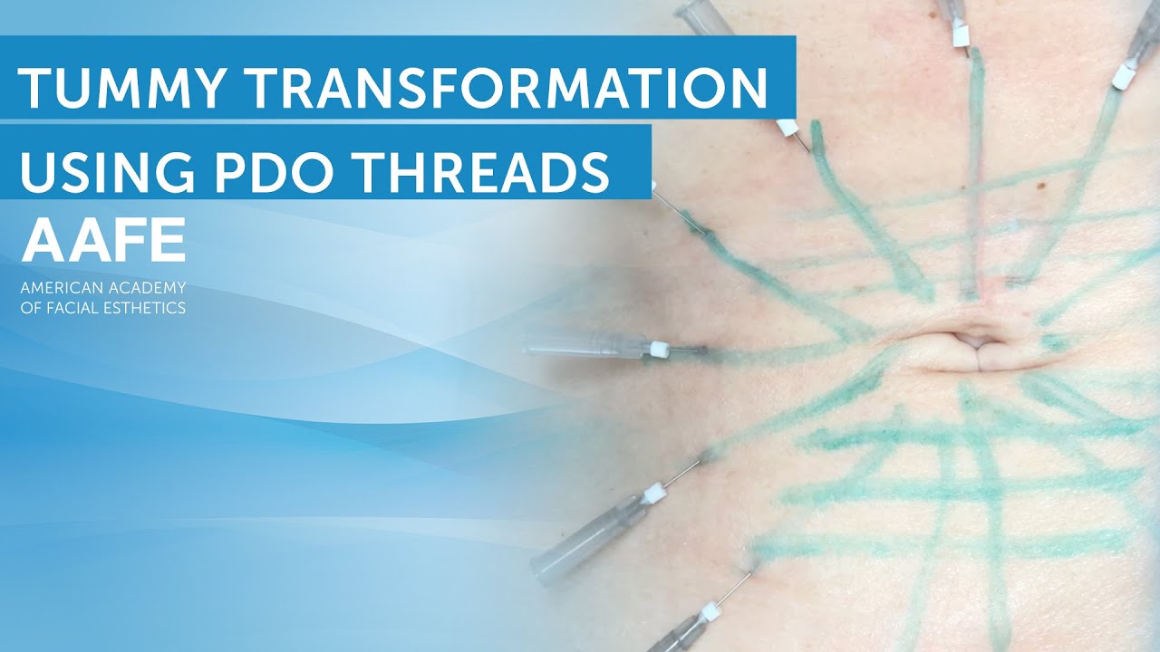 Body Threads Treatment + Before and After - YouTube