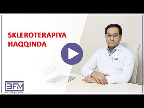 Varikoz Damar Müalicəsi. Skleroterapiya haqqında.