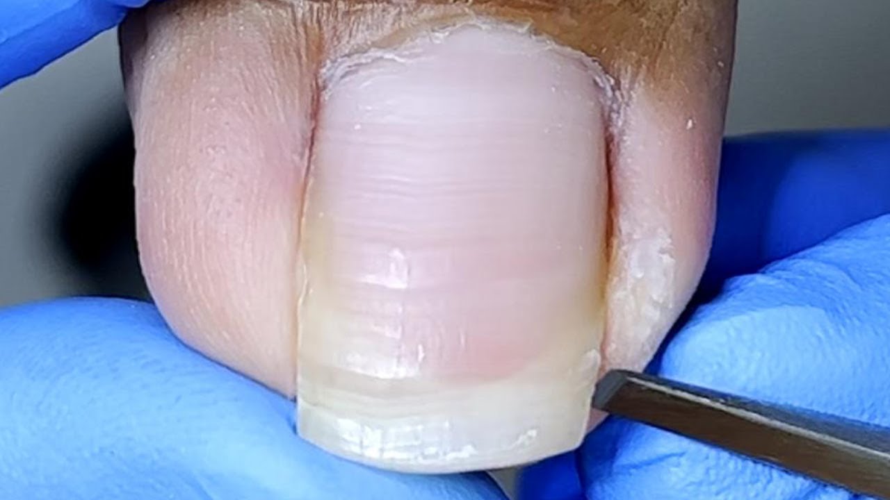 Square toenails are long, be careful with pedicures【Xue Yidao】 - YouTube