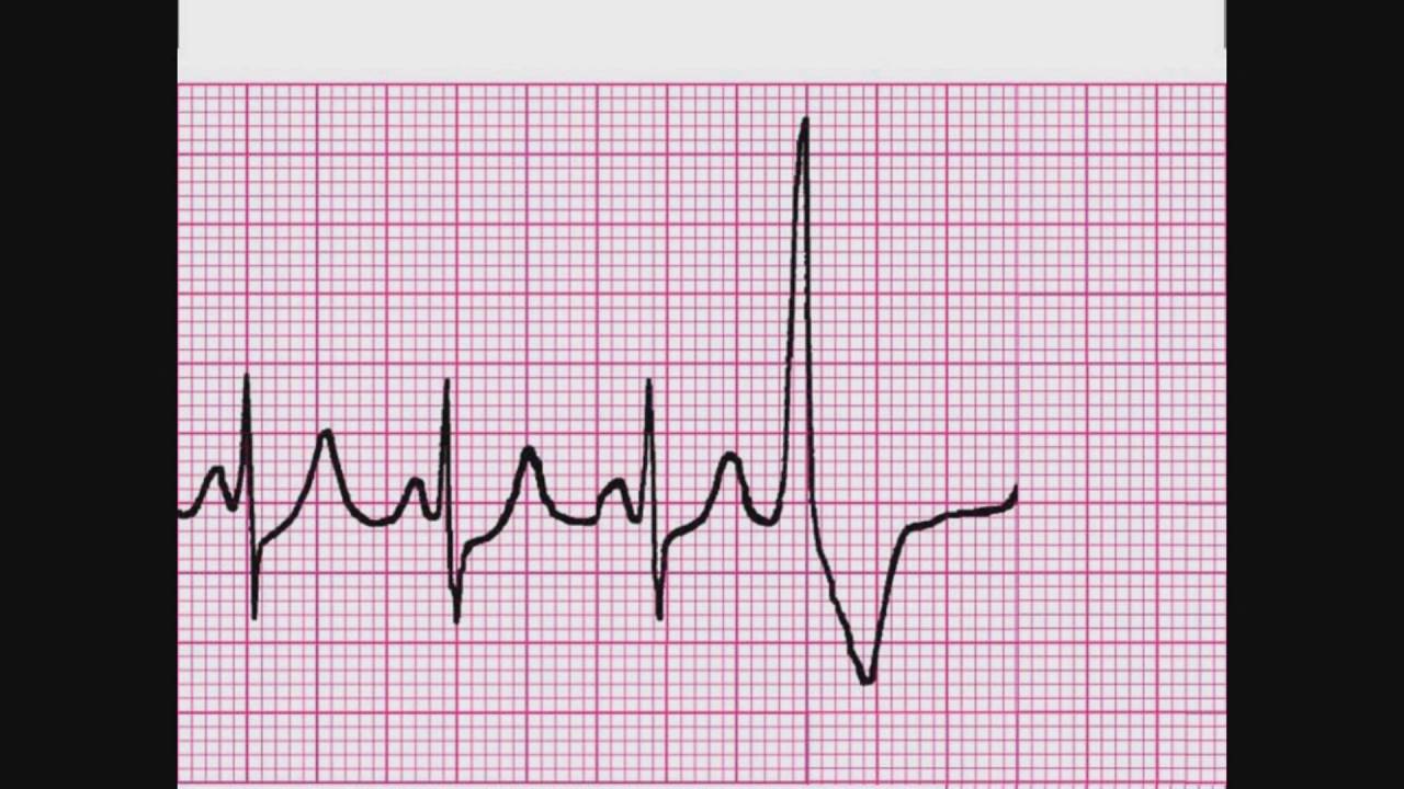 Auscultacion de las extrasístoles ventriculares - YouTube